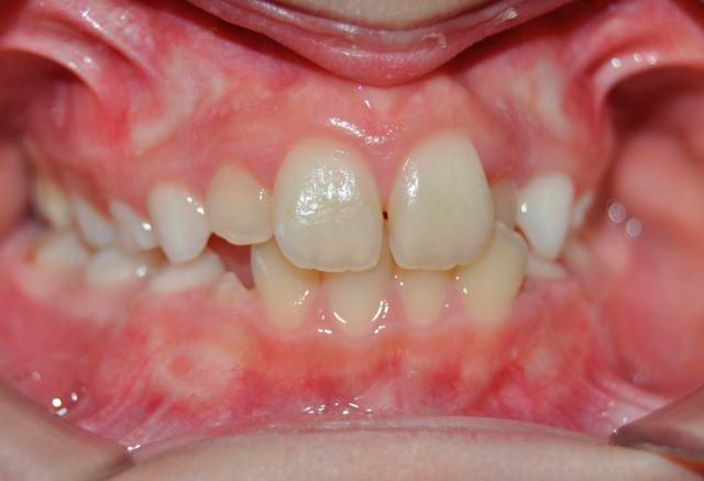 Caso real de ortopedia dental, ortodoncia con brackets y estética ...