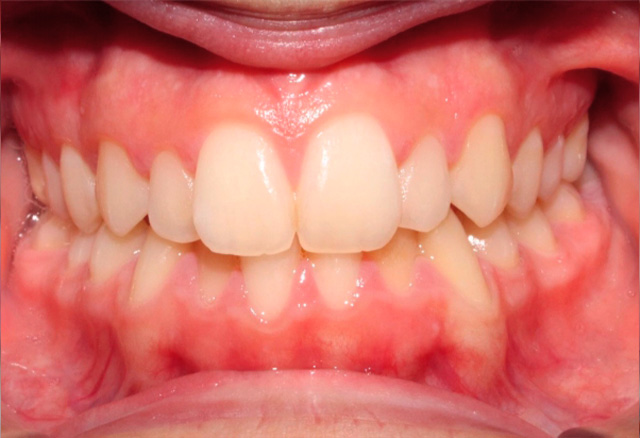 Caso real de ortopedia dental, ortodoncia con brackets y estética ...