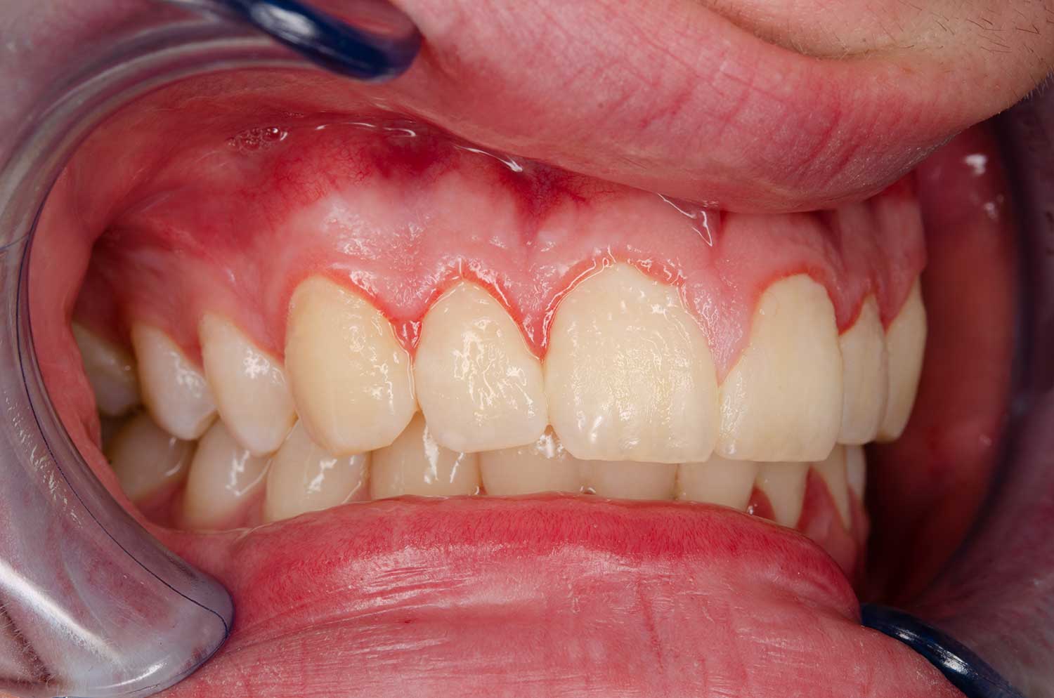 Ortodoncia con periodontitis. ¿Es posible?